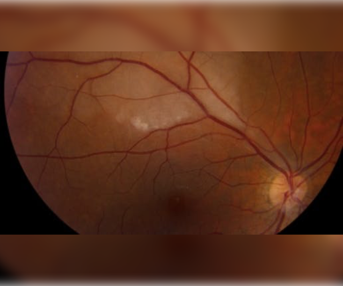 Branch Retinal Artery Occlusion in Patient with Vision Loss and ...