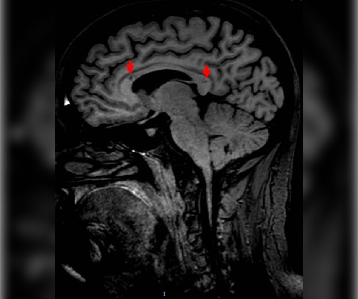 The Classic Triad of Susac Syndrome | Figure 1