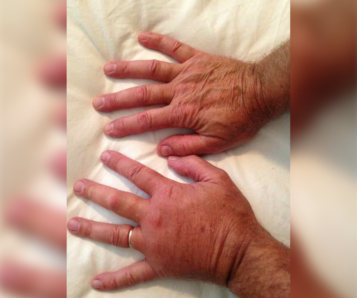 Psoriatic Arthritis: Clinical Findings and Patterns of Presentation ...