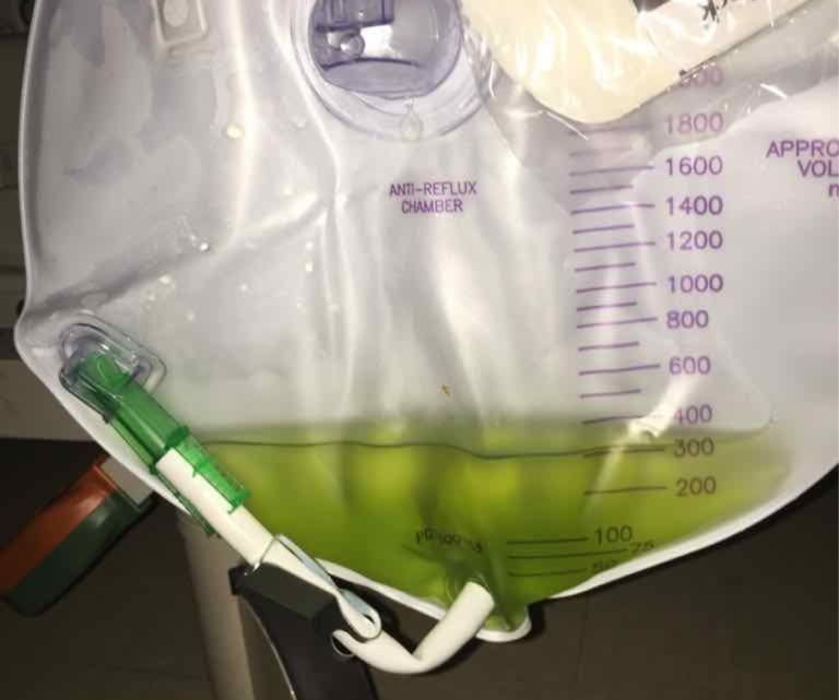 Unusual Urine Color Presentations | Figure 1