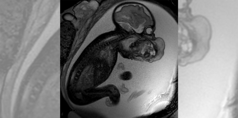 The Most Interesting Medical Cases of Teratomas | Figure 1